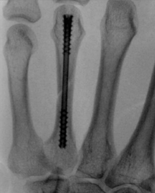NX Nail for fixation of spiral fracture of fourth metacarpal.